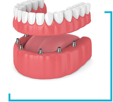 Mini Implants Hold Dentures - San Antonio Dentist | Dr. Gregory R Bowen ...